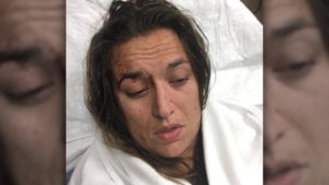 GRAPHIC CONTENT WARNING: Injuries caused by early August hailstorm